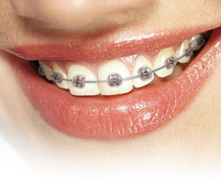 Braces | Rosenthall Orthodontics | Muncie Indiana